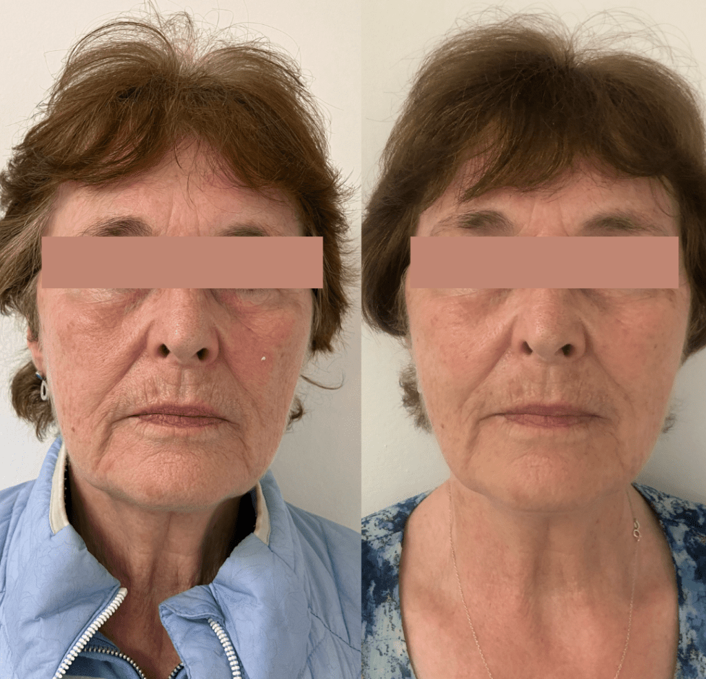 Liquid Face Lift - Meet Soniya Behrens